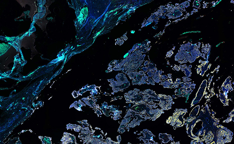 Cancer: Research & Insights | WEHI