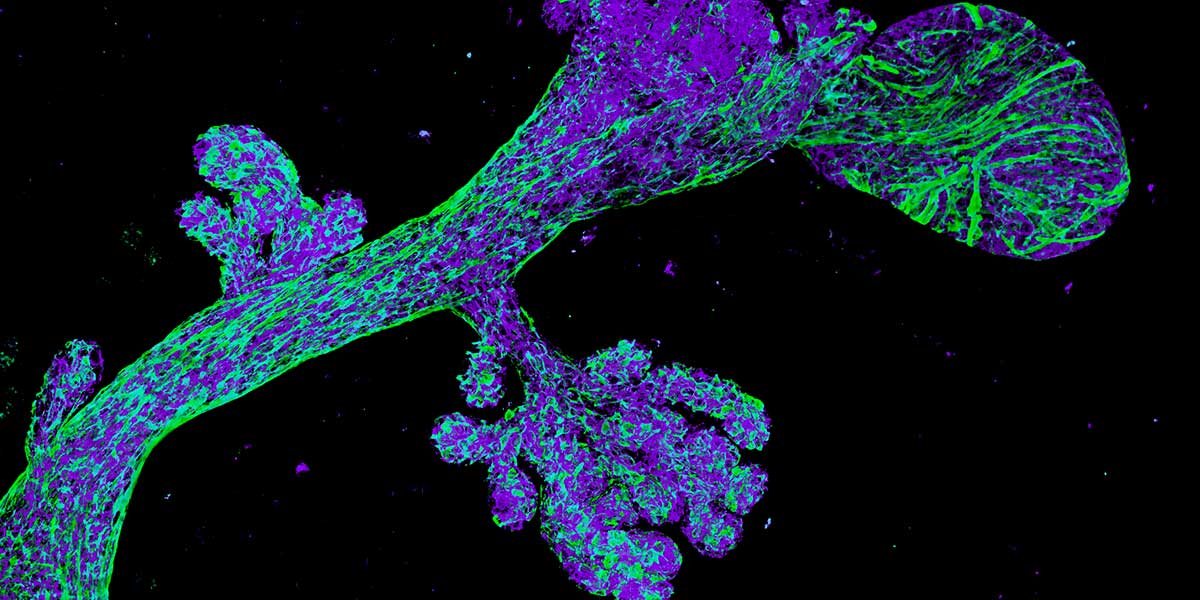 Study pinpoints breast cancer ‘cells-of-origin’ in high-risk women | WEHI