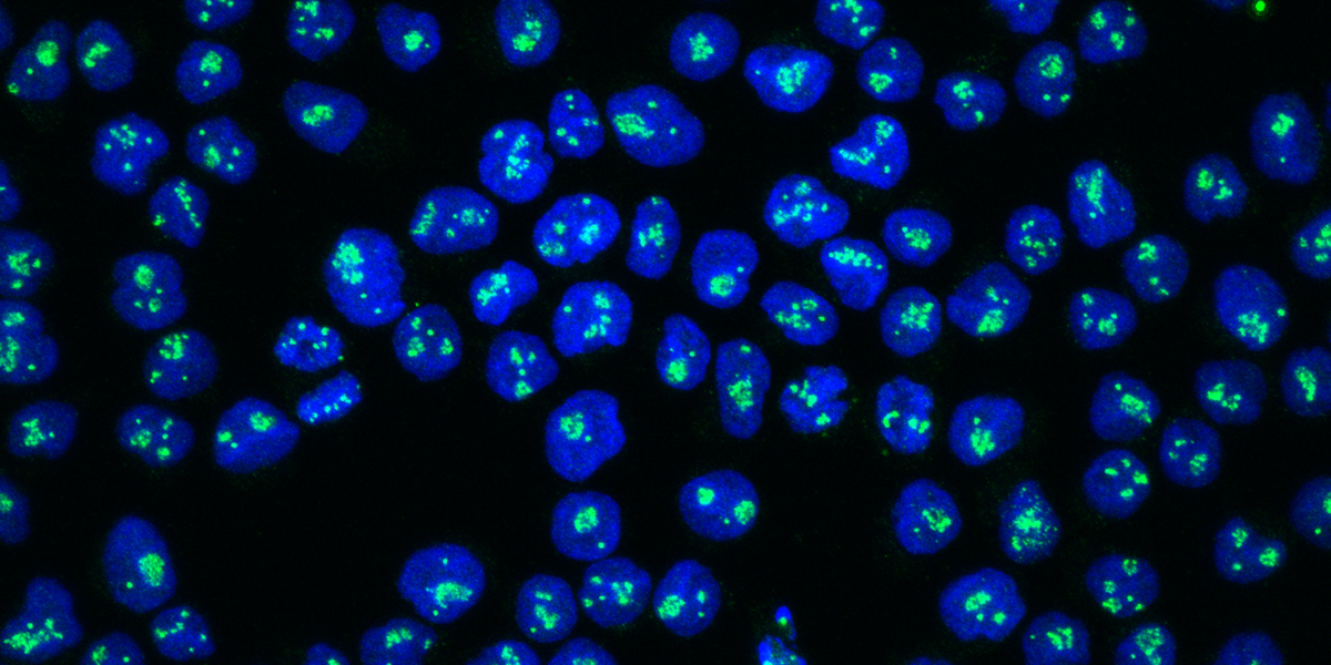 Protein discovery sparks treatment hope for aggressive blood cancer | WEHI